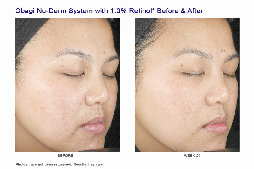 OBAGI Nu-Derm® -Exfoderm / LENGVAS KREMAS-LOSJONAS NUO PIGMENTACIJOS ...